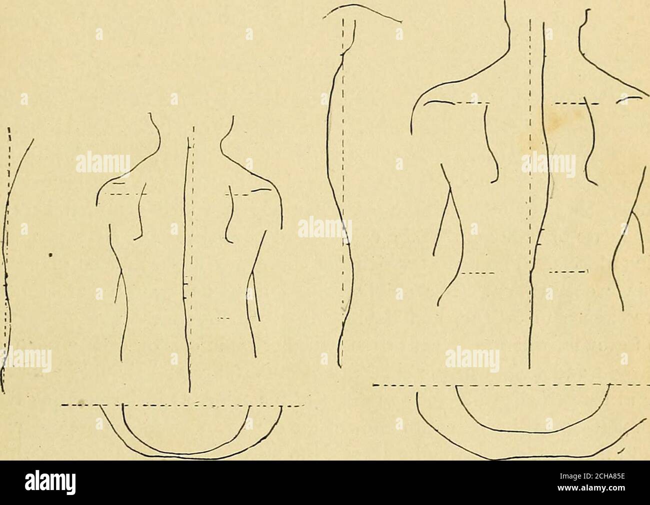 . Courbure latérale de la colonne vertébrale et des épaules rondes ...