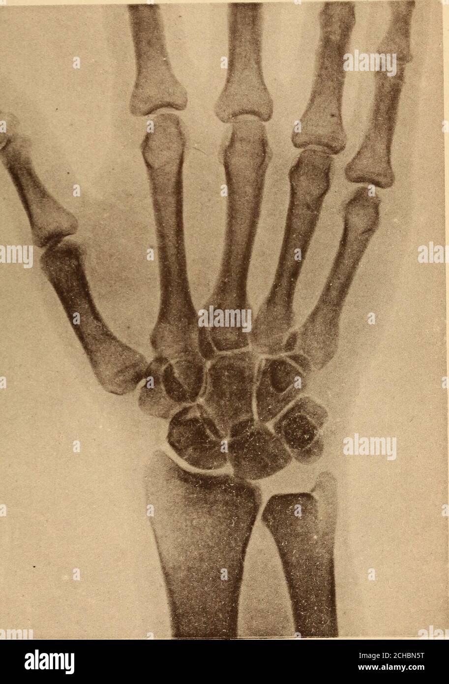 . Atlas et épitome du traumatique . Processus styoldcus ulnae rayon-- 8 ...