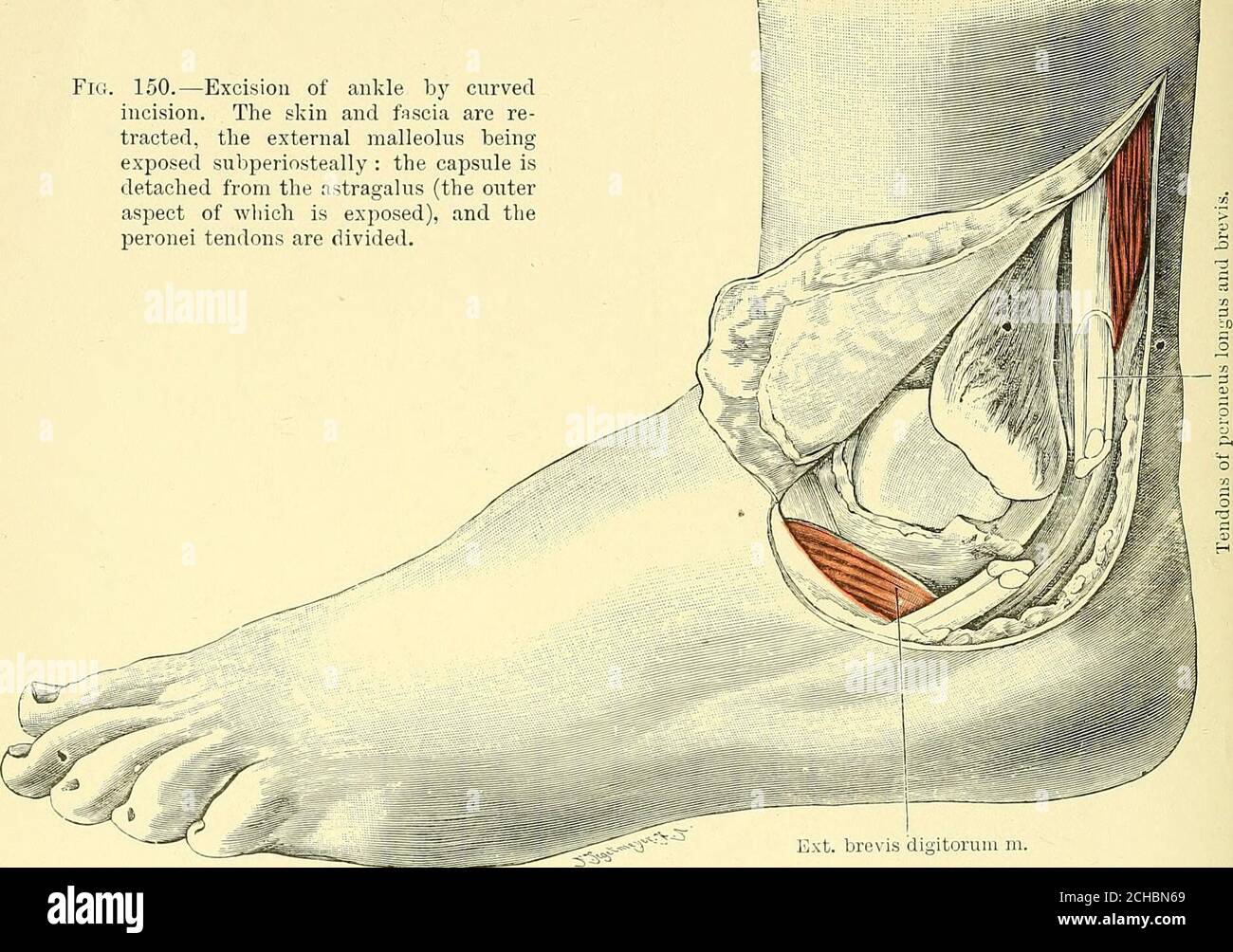. Texte-livre de chirurgie opératoire . est maintenant détaché le long ...
