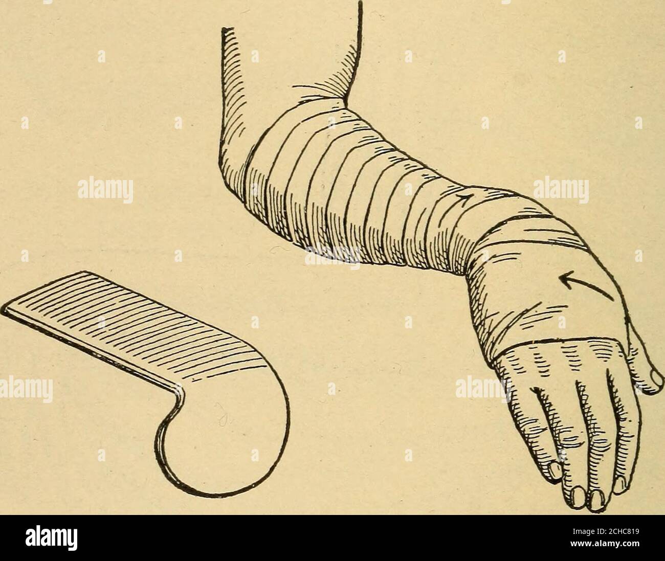 . Atlas et épitome de trauma . ys méthode.) placé vers l'ulna dans son ...