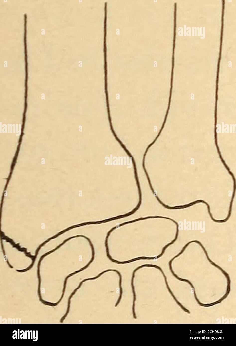 . Atlas et épitome du traumatique . W et Fig. 94 a et b.—formes ...