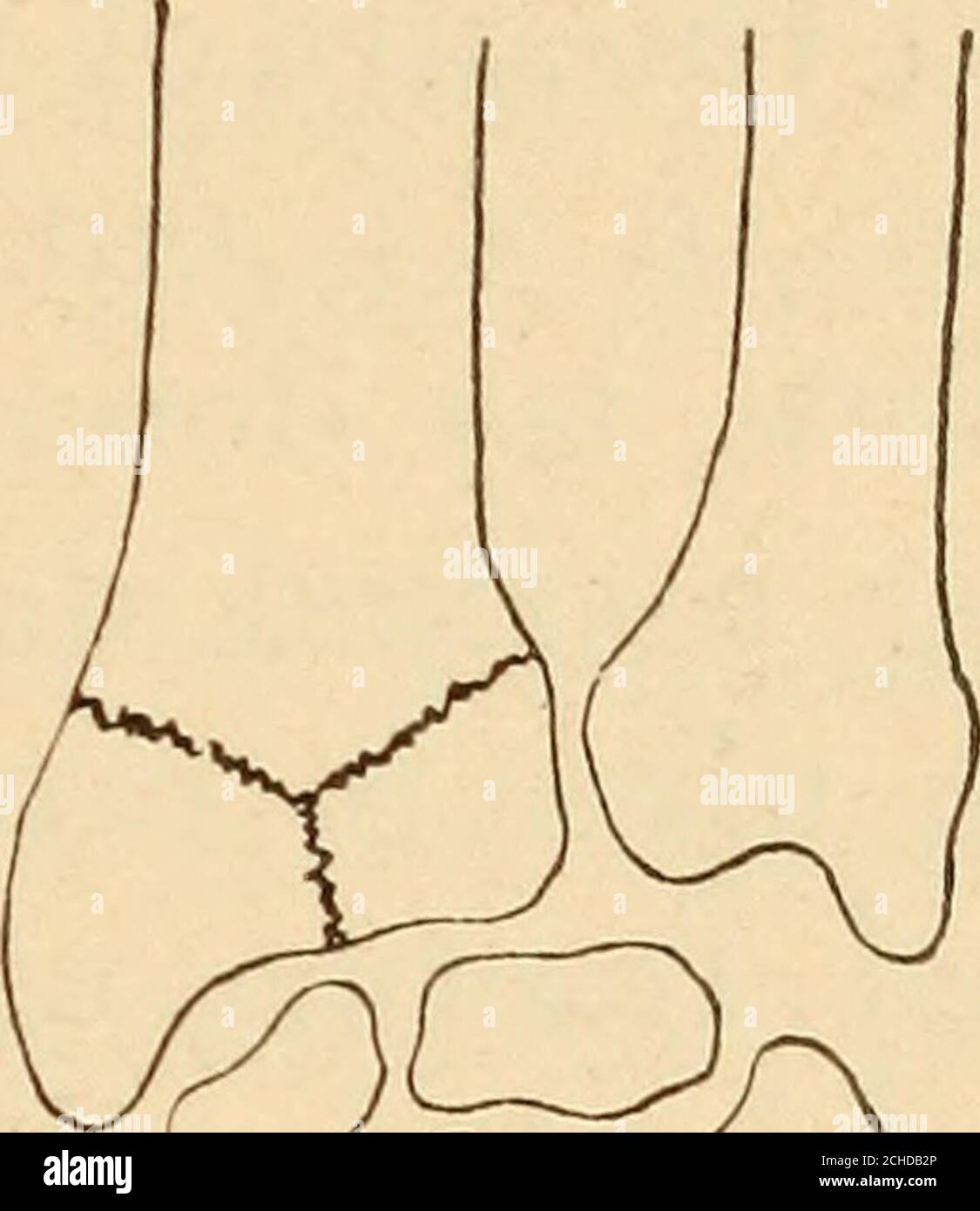 . Atlas et épitome du traumatique . W et Fig. 94 a et b.—formes ...