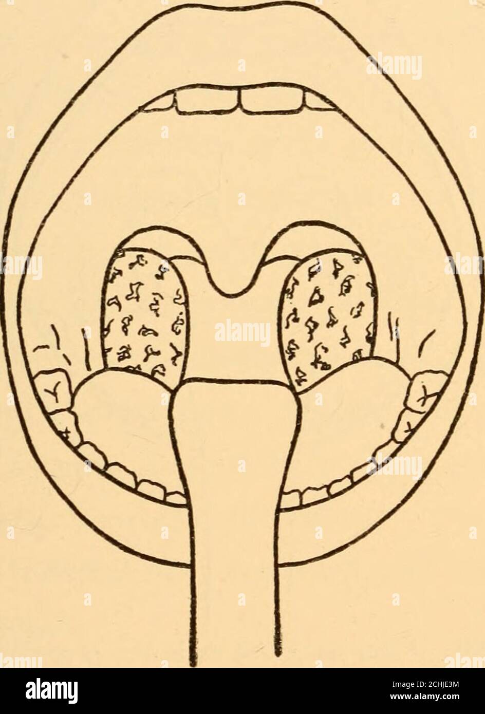 Tonsil Membrane Banque d'image et photos - Alamy