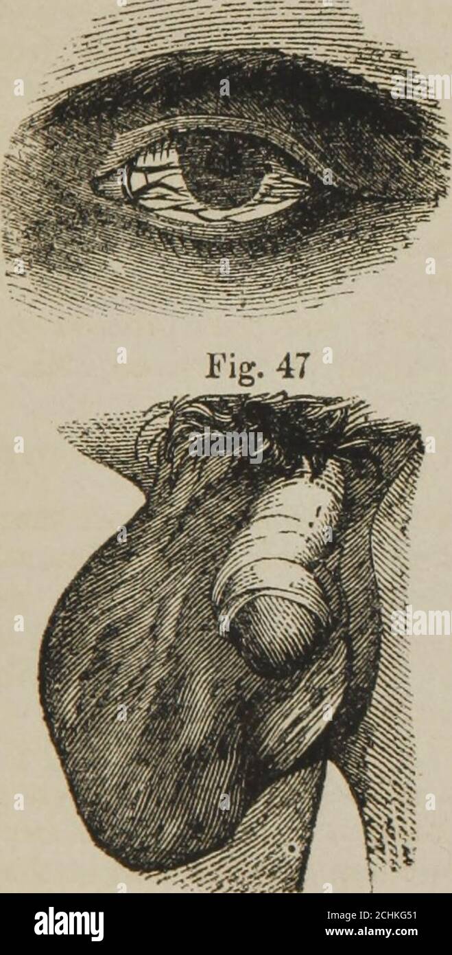 Chancre syphilitique Banque de photographies et d’images à haute ...