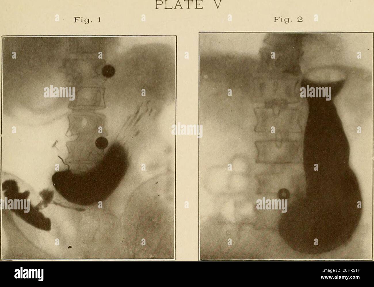 . Maladies de l'estomac : y compris traitement diététique et médicinal ...
