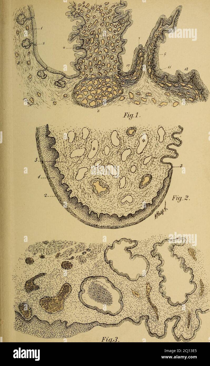 . Atlas et épitome de la gynécologie . olapsed uteri est apparent à ...