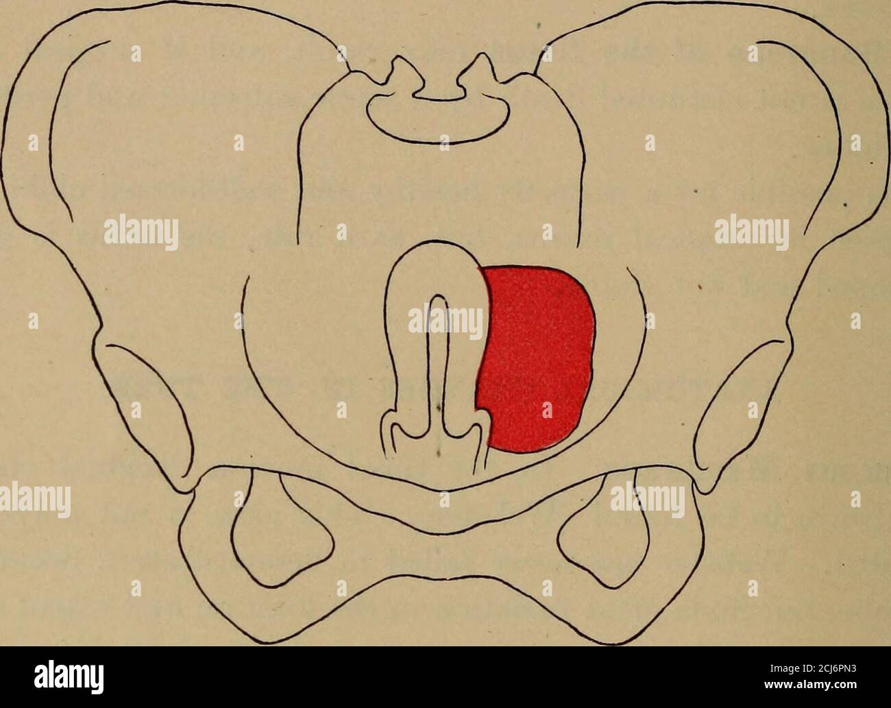 . Le diagnostic des maladies des femmes . un decidua vera, réflexa, et ...