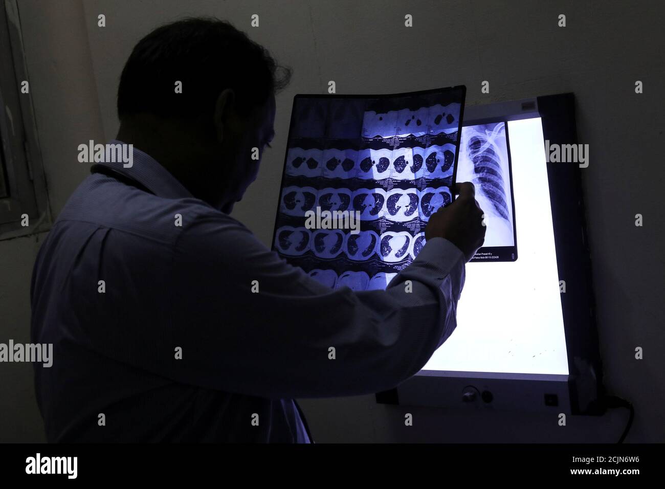 Scanner thoracique des poumons Banque de photographies et d’images à ...