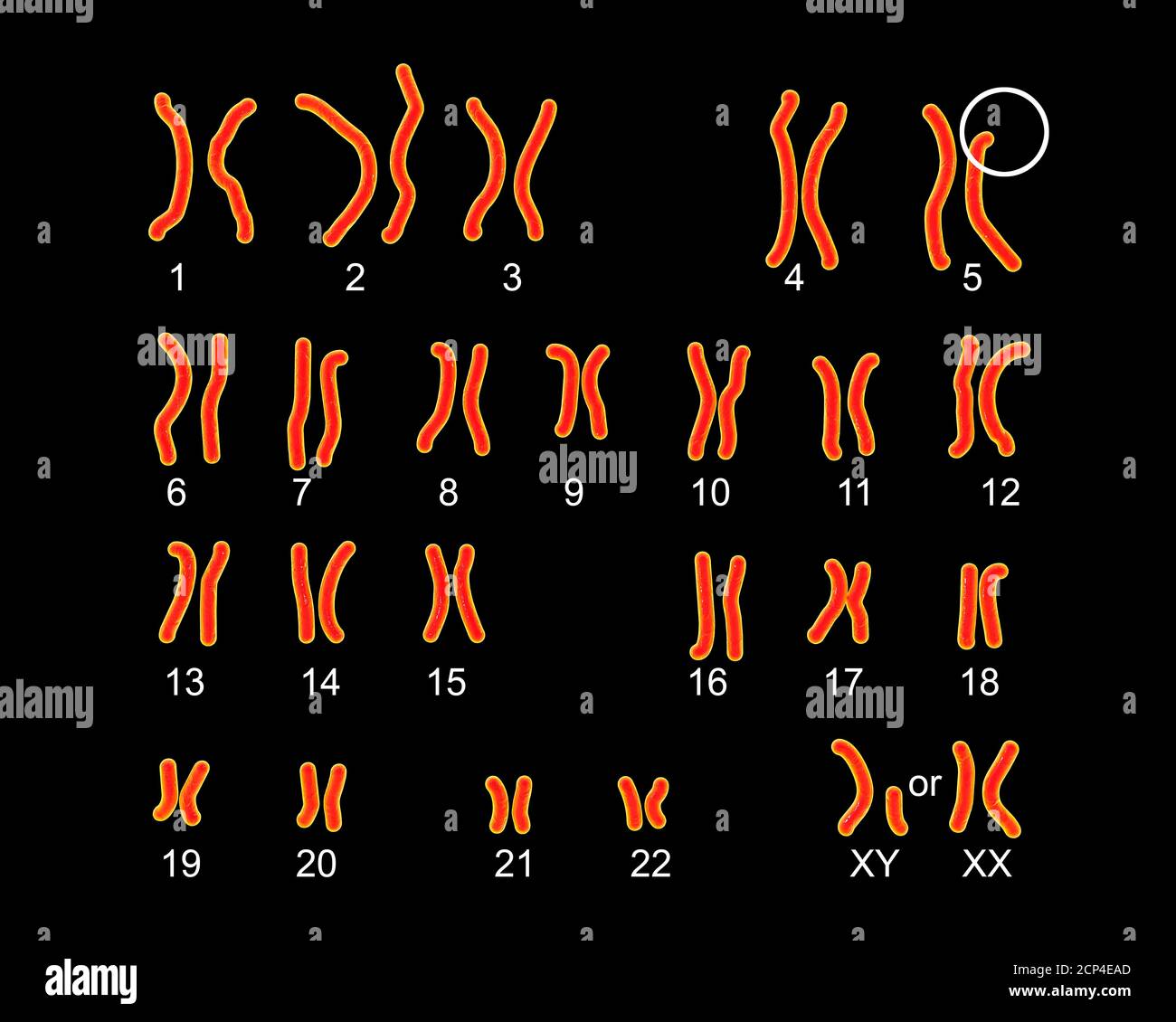 Cri Du Chat Syndrome Karyotypes Banque De Photographies Et Dimages à