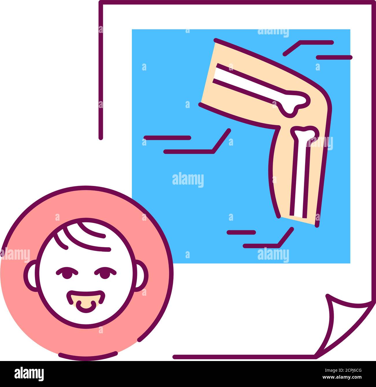 Fracture osseuse de l'enfant Banque d'images vectorielles - Alamy