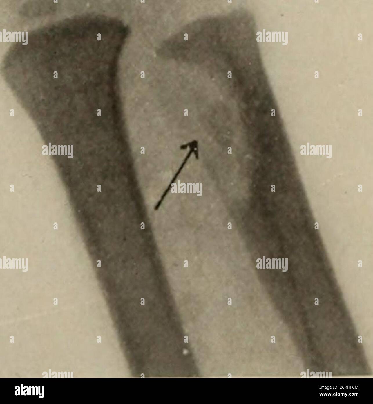 . Anatomie et pathologie vivantes; . PLAQUE 247.TUBERCULOSE DES OS ...