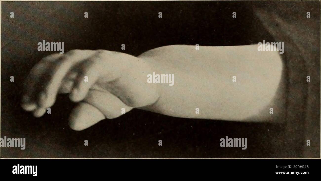 . Anatomie et pathologie vivantes; . TÔLE 219. OSTÉOMYÉLITE. Figure 1 ...