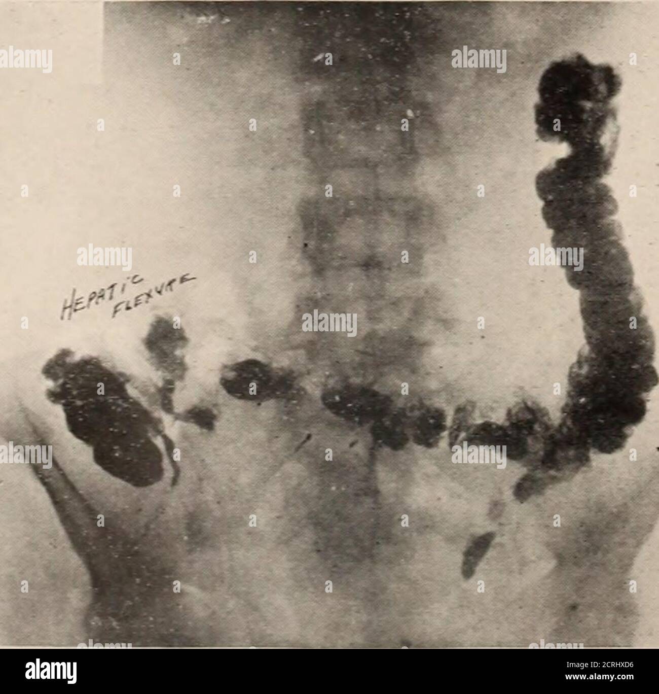 Cavidad peritoneal de la pelvis Banque de photographies et d’images à ...