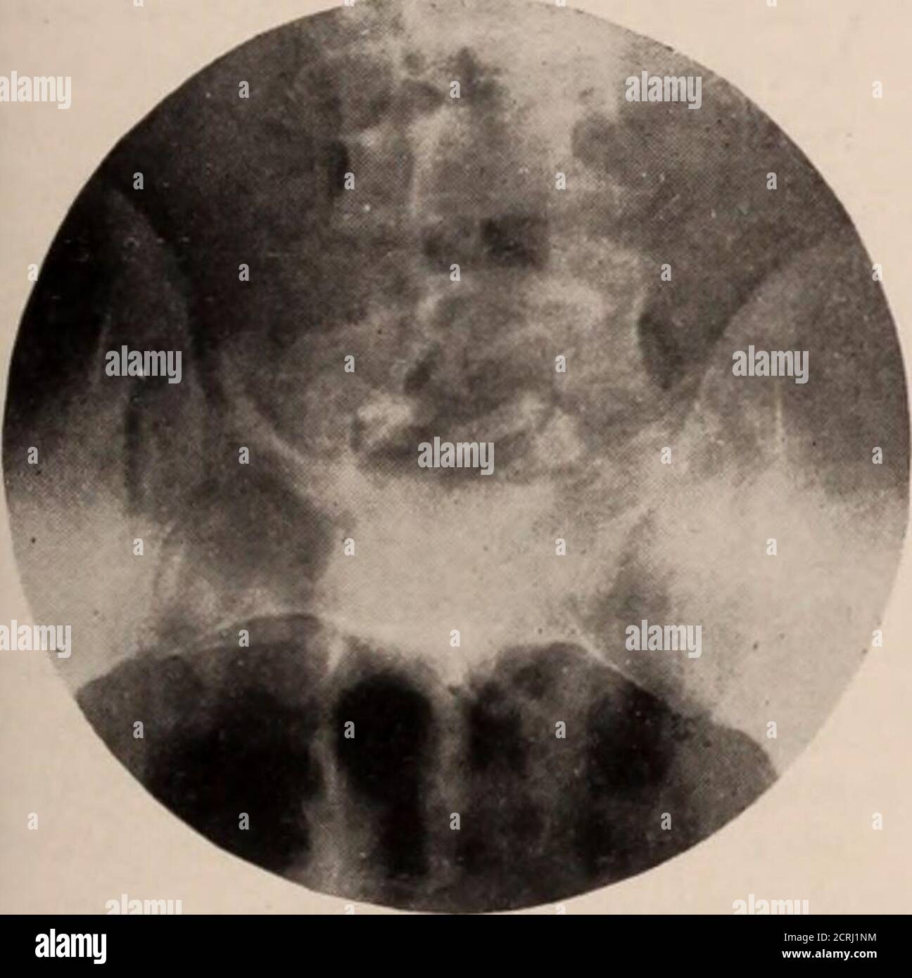 Cas De Spina Bifida Banque d'image et photos - Alamy