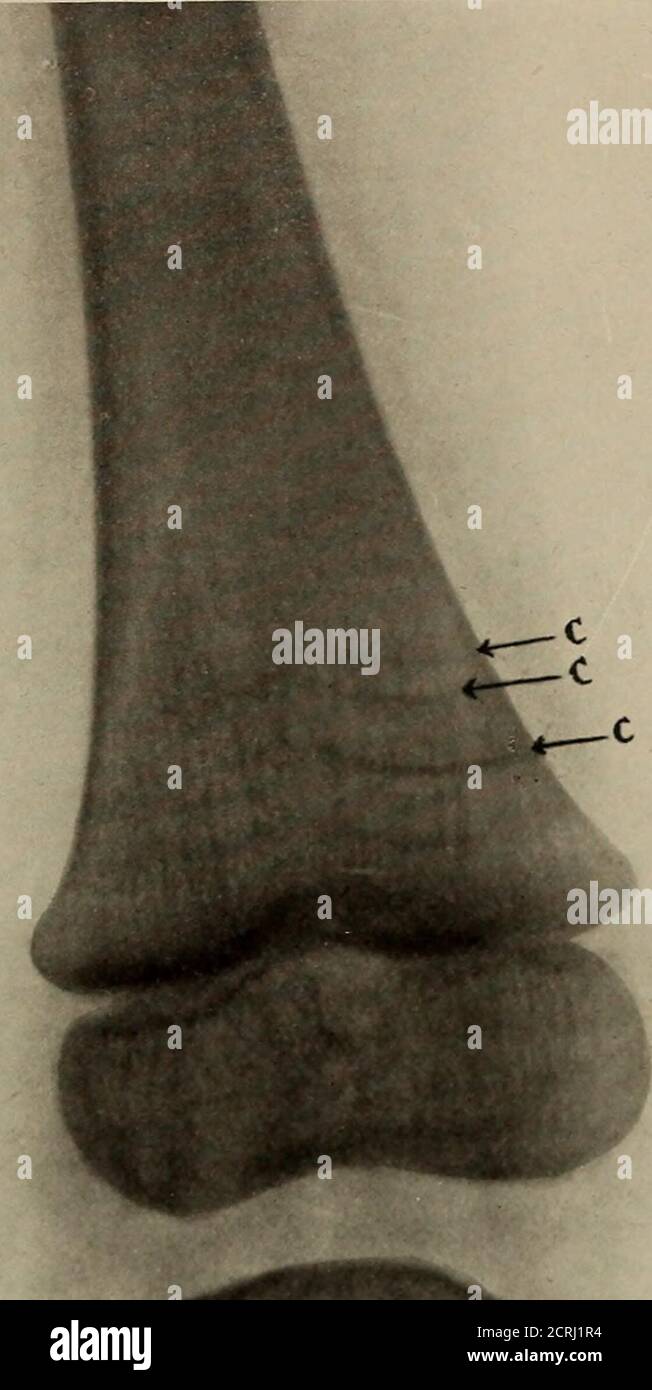 Fracture de la jambe Banque de photographies et d’images à haute ...