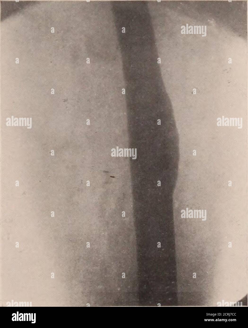 Sarcome cuisse Banque de photographies et d’images à haute résolution ...