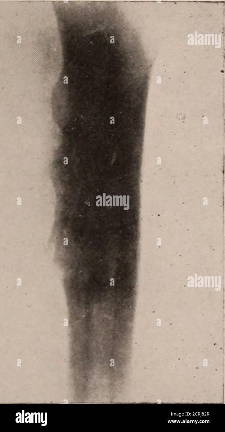 . Journal de radiologie . L. Figure I.—cas I.—Pathol. N° 16865 ...