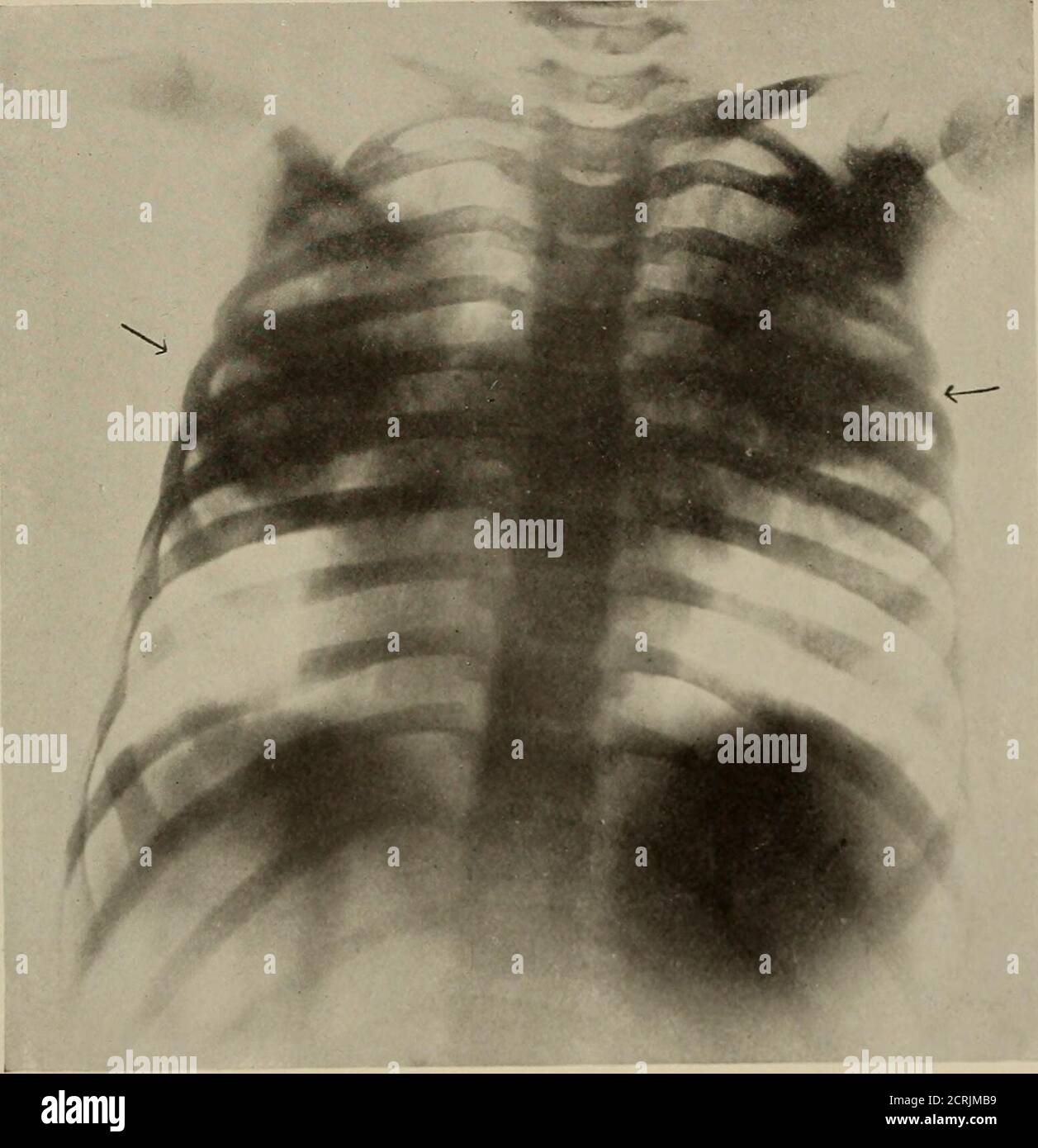 Tuberculose miliaire Banque de photographies et d’images à haute ...