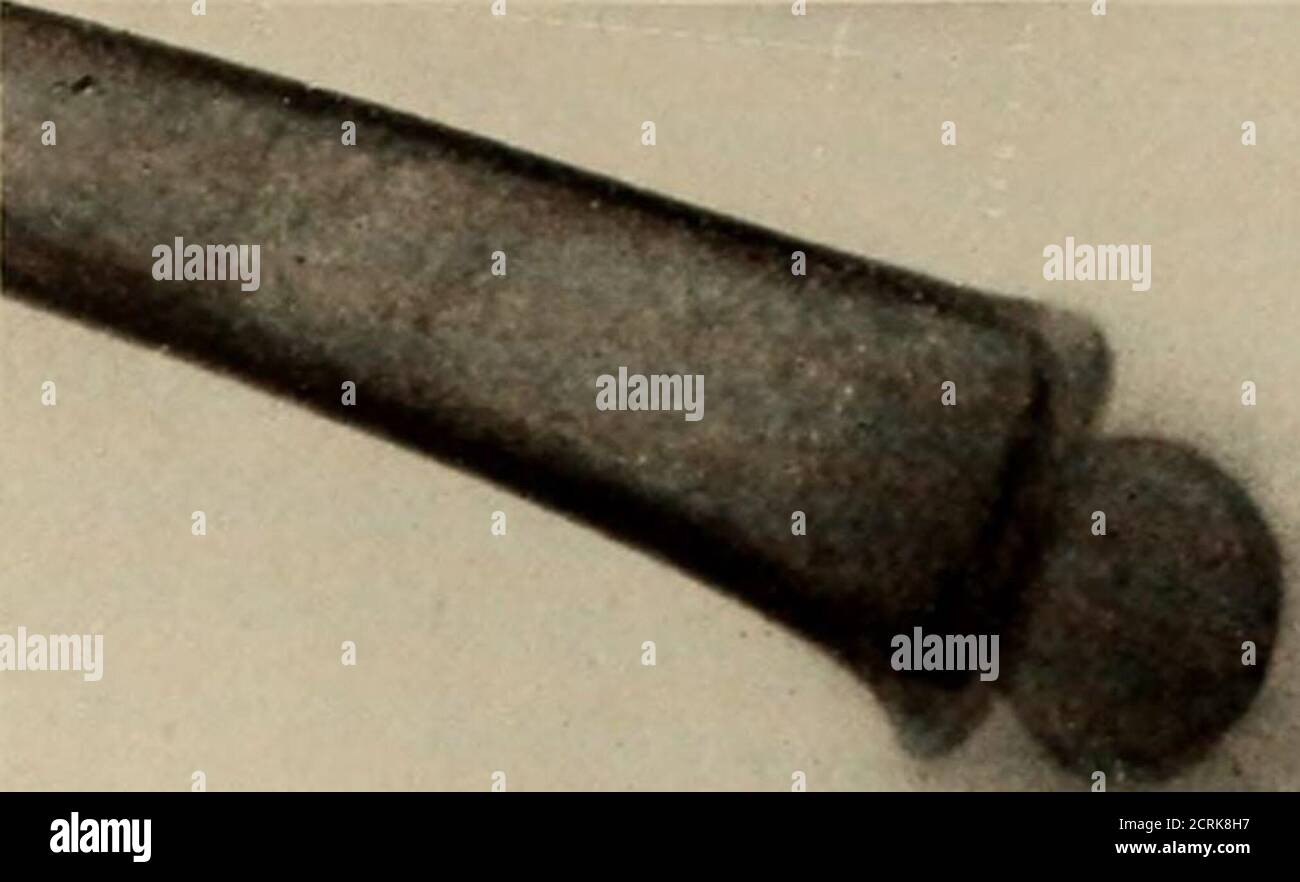 . Anatomie et pathologie vivantes; . TÔLE 75. ATROPHIE INFANTILE ...