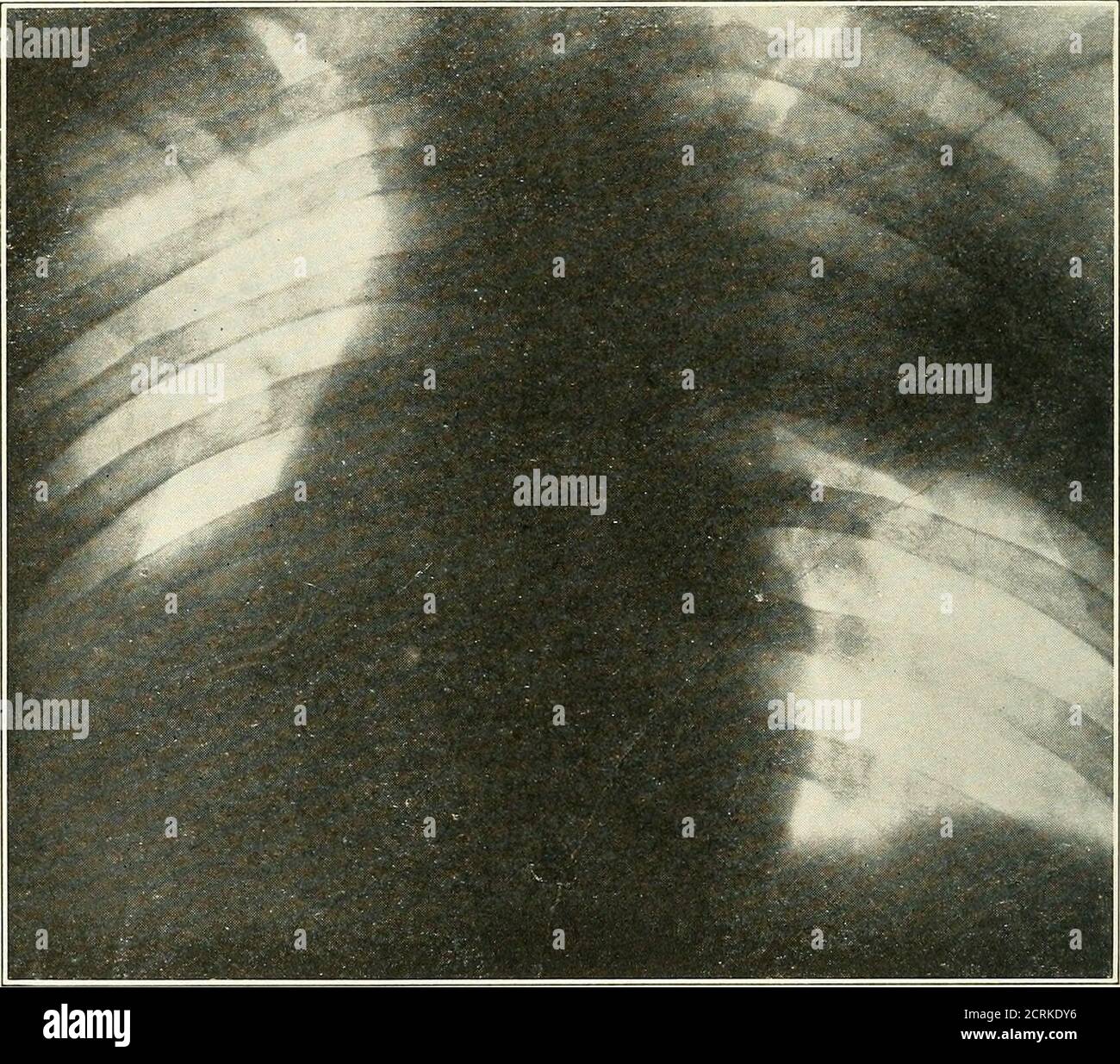 Tuberculose miliaire Banque de photographies et d’images à haute ...