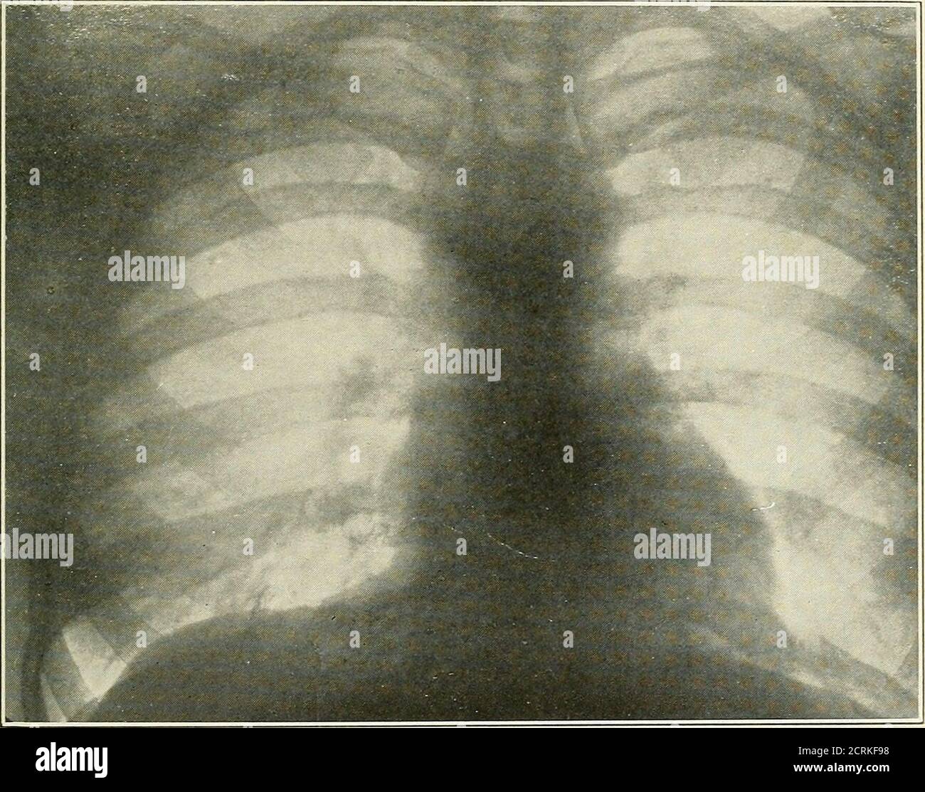 Calcification pleurale Banque de photographies et d’images à haute ...