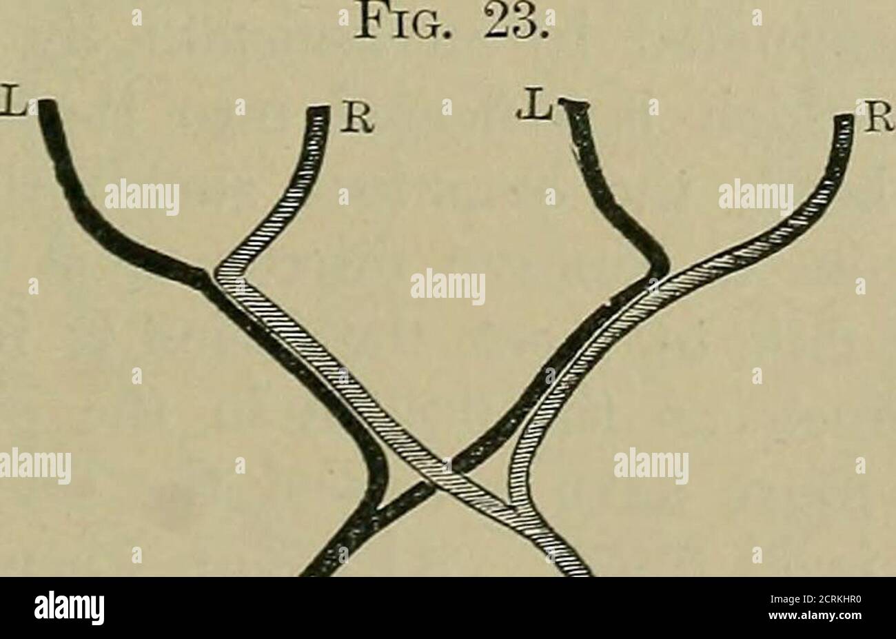 Scotome central Banque de photographies et d’images à haute résolution ...