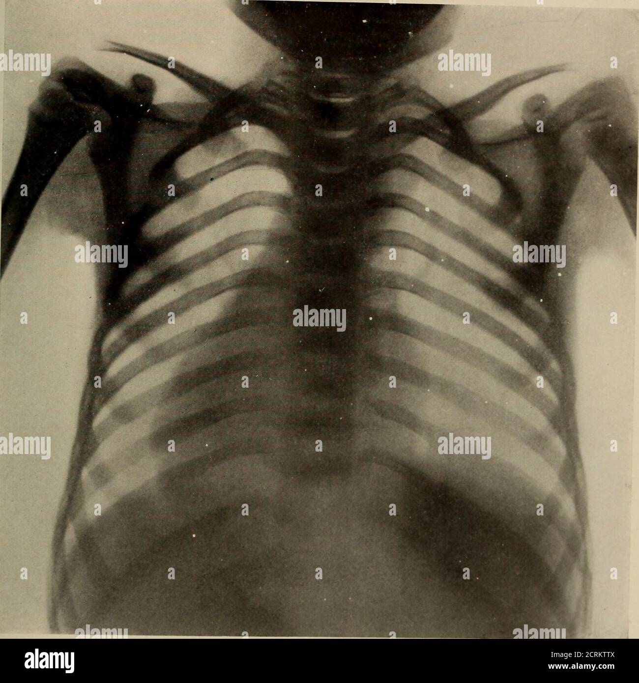 . Anatomie et pathologie vivantes; . PLAQUE 17.COUDE NORMAL. 6 ans ...