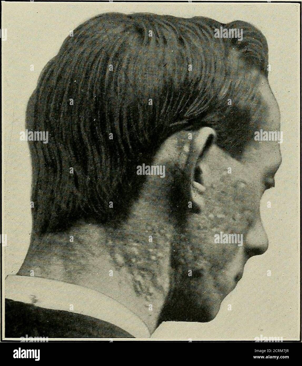 Keloidal scars Banque de photographies et d’images à haute résolution ...