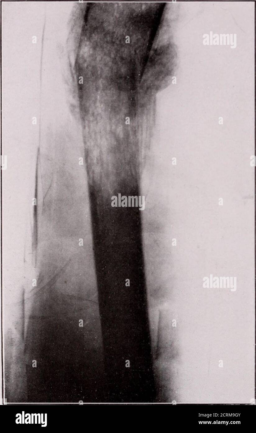 Fracture pathologique Banque de photographies et d’images à haute ...