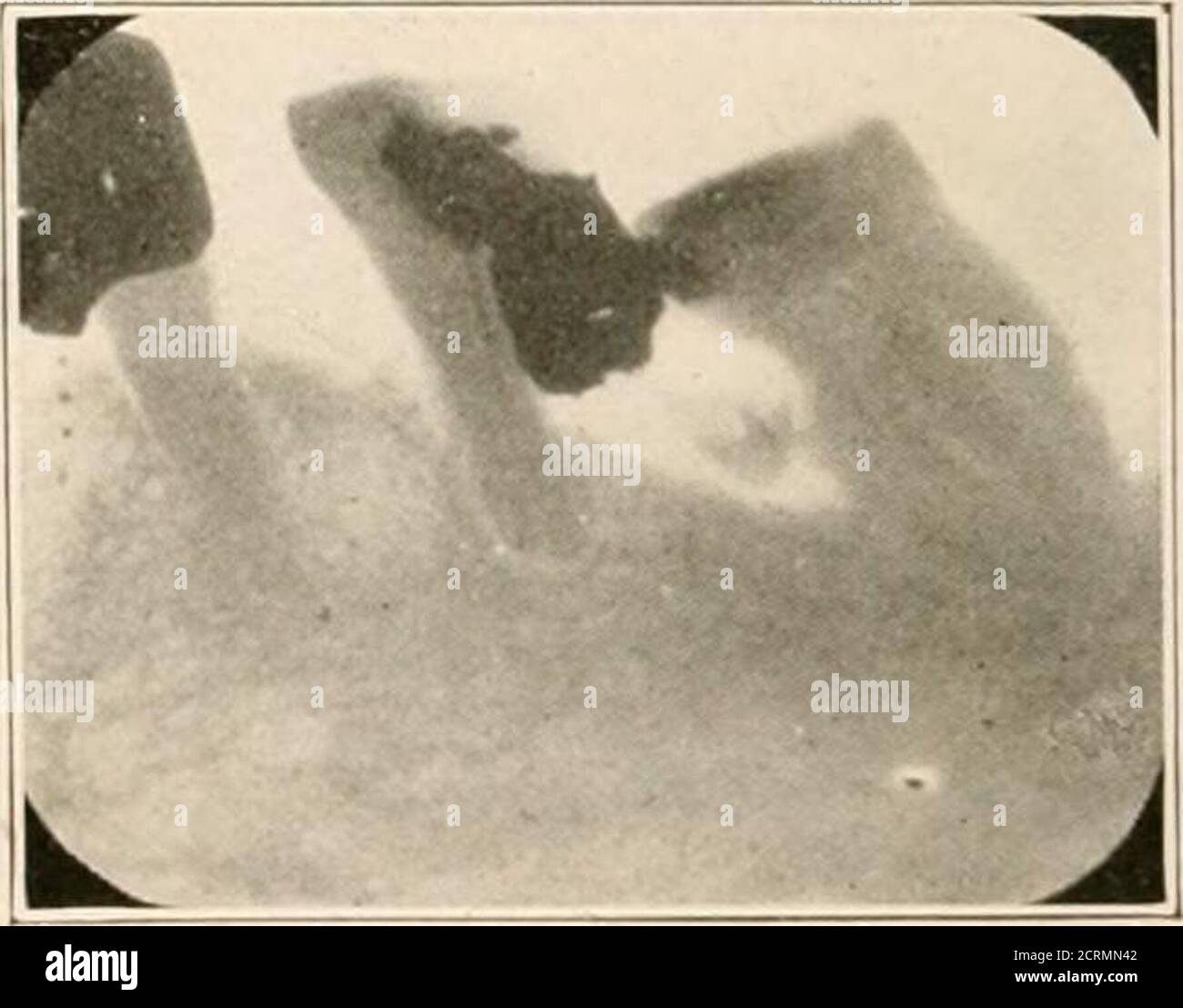 Angine de vincent Banque de photographies et d’images à haute ...