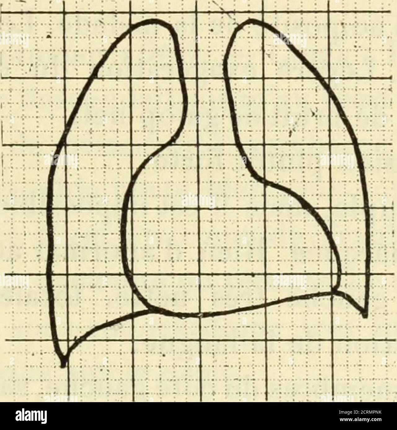 . Les formes de l'aire de projection du coeur pathologique : étude de ...