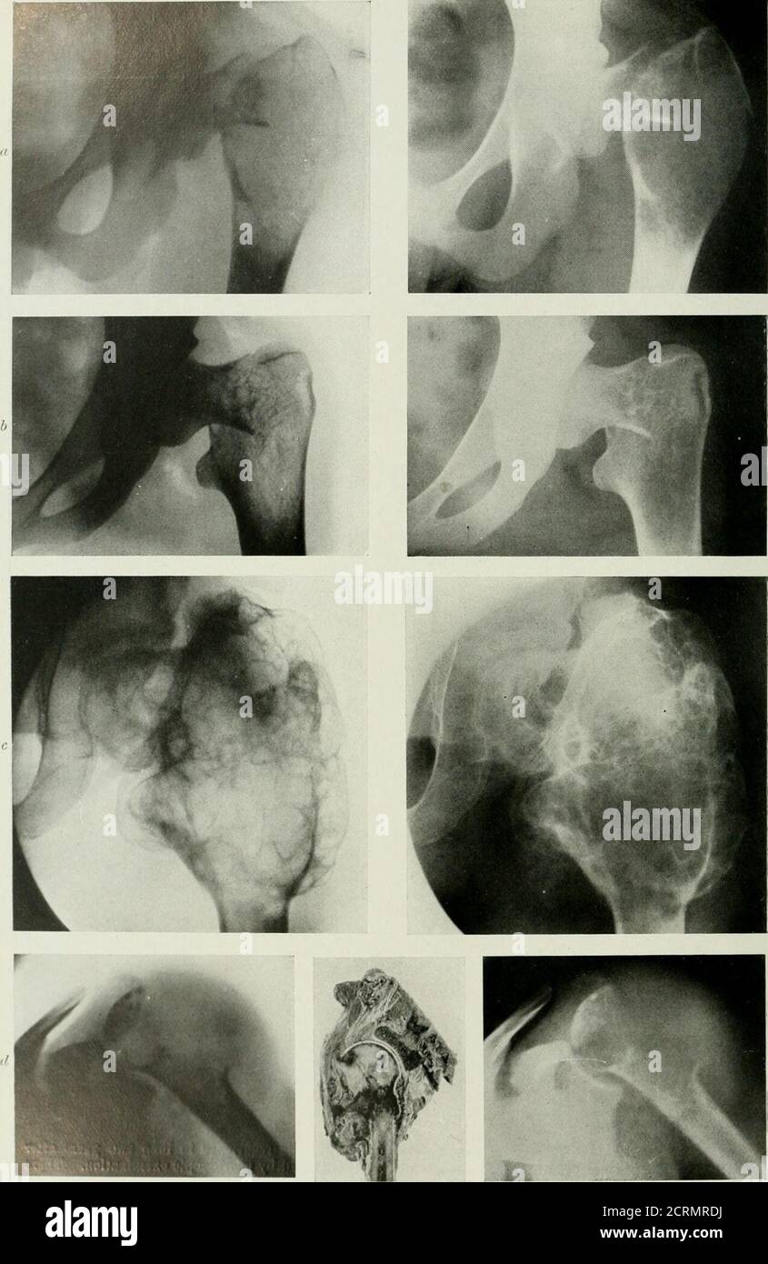 Fractures des plaques de croissance Banque de photographies et d’images ...