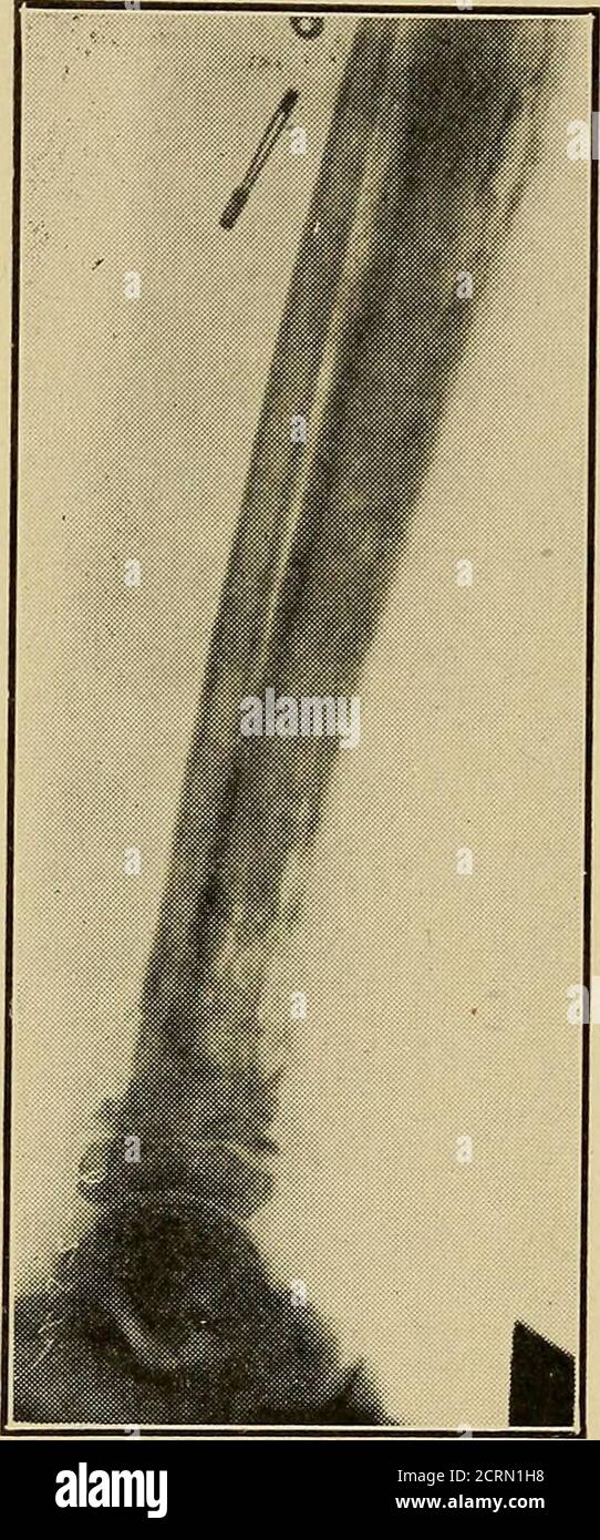 Os trabéculaire fibreux Banque de photographies et d’images à haute ...