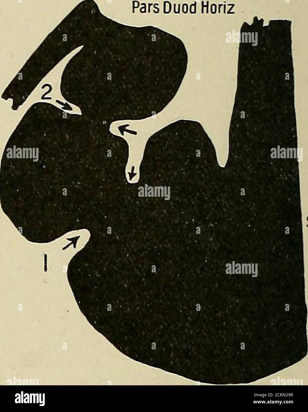 . Radiographie et radiothérapeutique . Fundus Corpus Antrum. Sinus ...