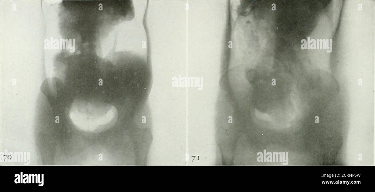 . La revue américaine de roentgoenologie, de radium thérapie et de ...