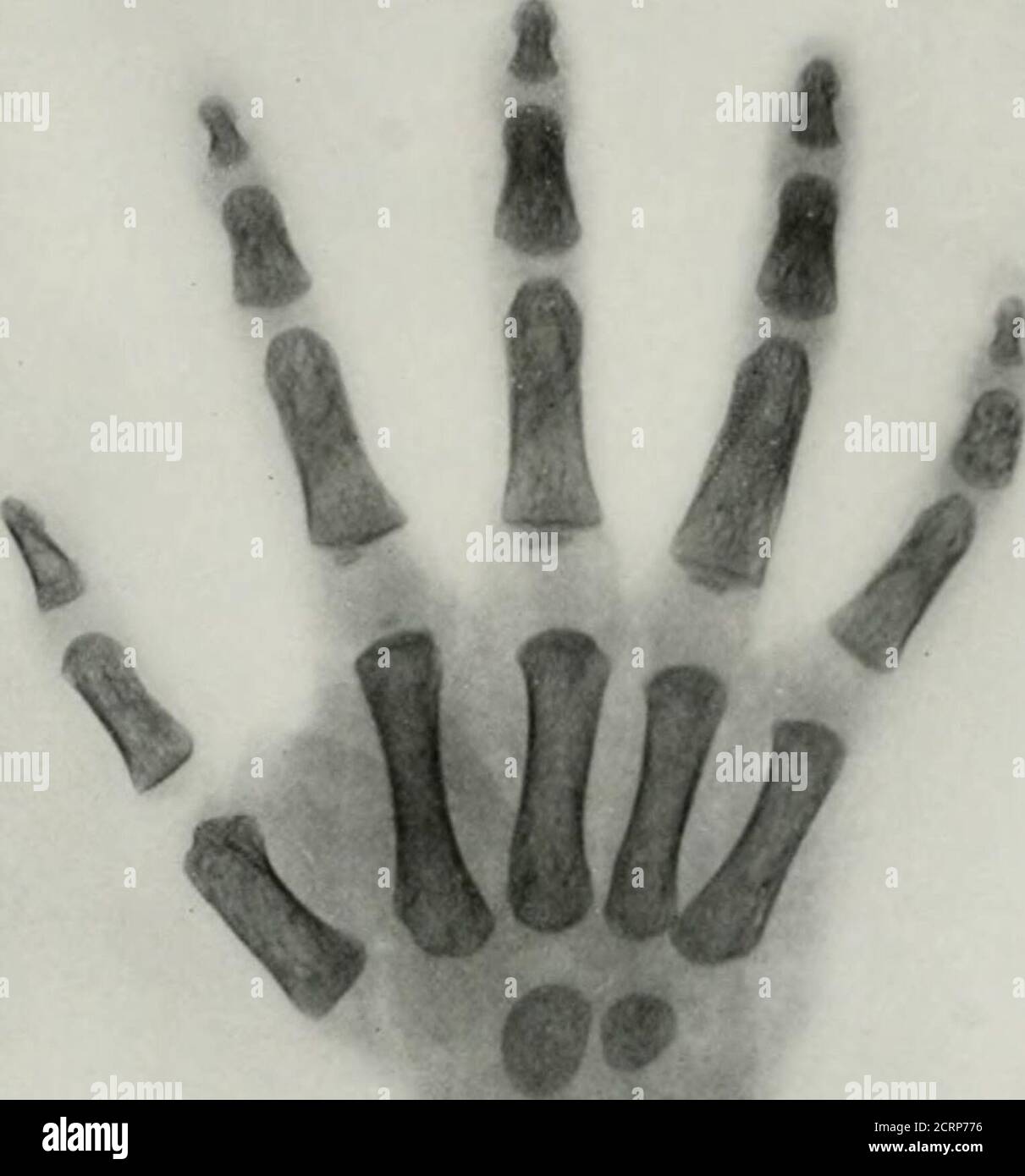 Une tuberculose Banque de photographies et d’images à haute résolution ...