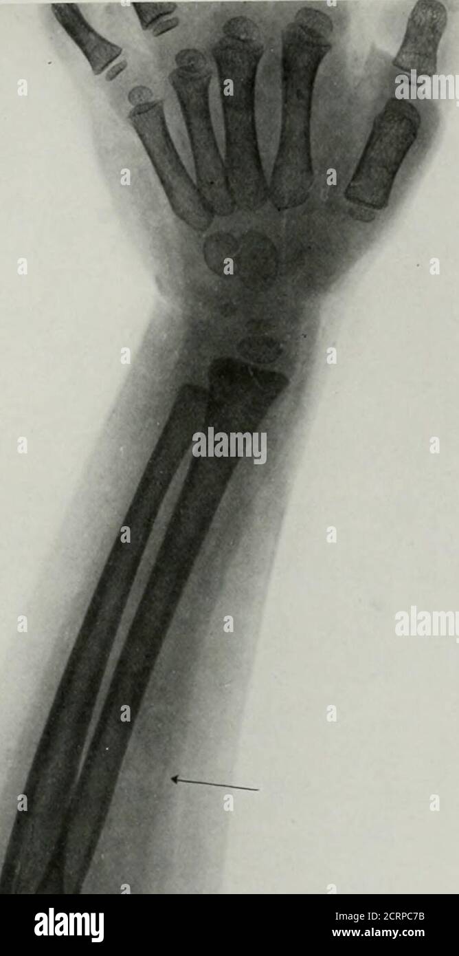 Hémorragie bras Banque de photographies et d’images à haute résolution ...