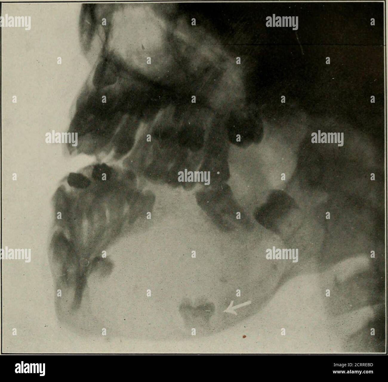 . Radiographie élémentaire et dentaire . Figure 256. Kyste osseux de la ...