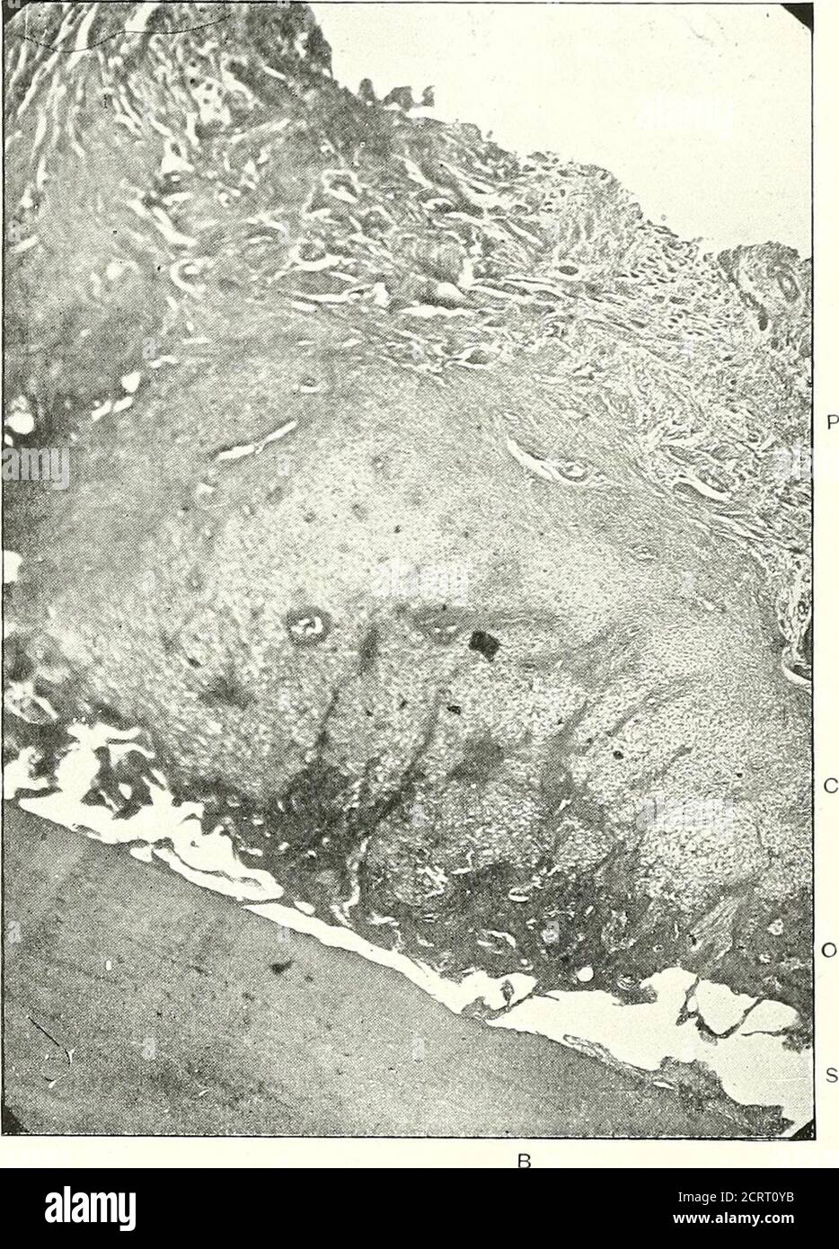 . Sur les méthodes modernes de traitement des fractures . e d'autre ...