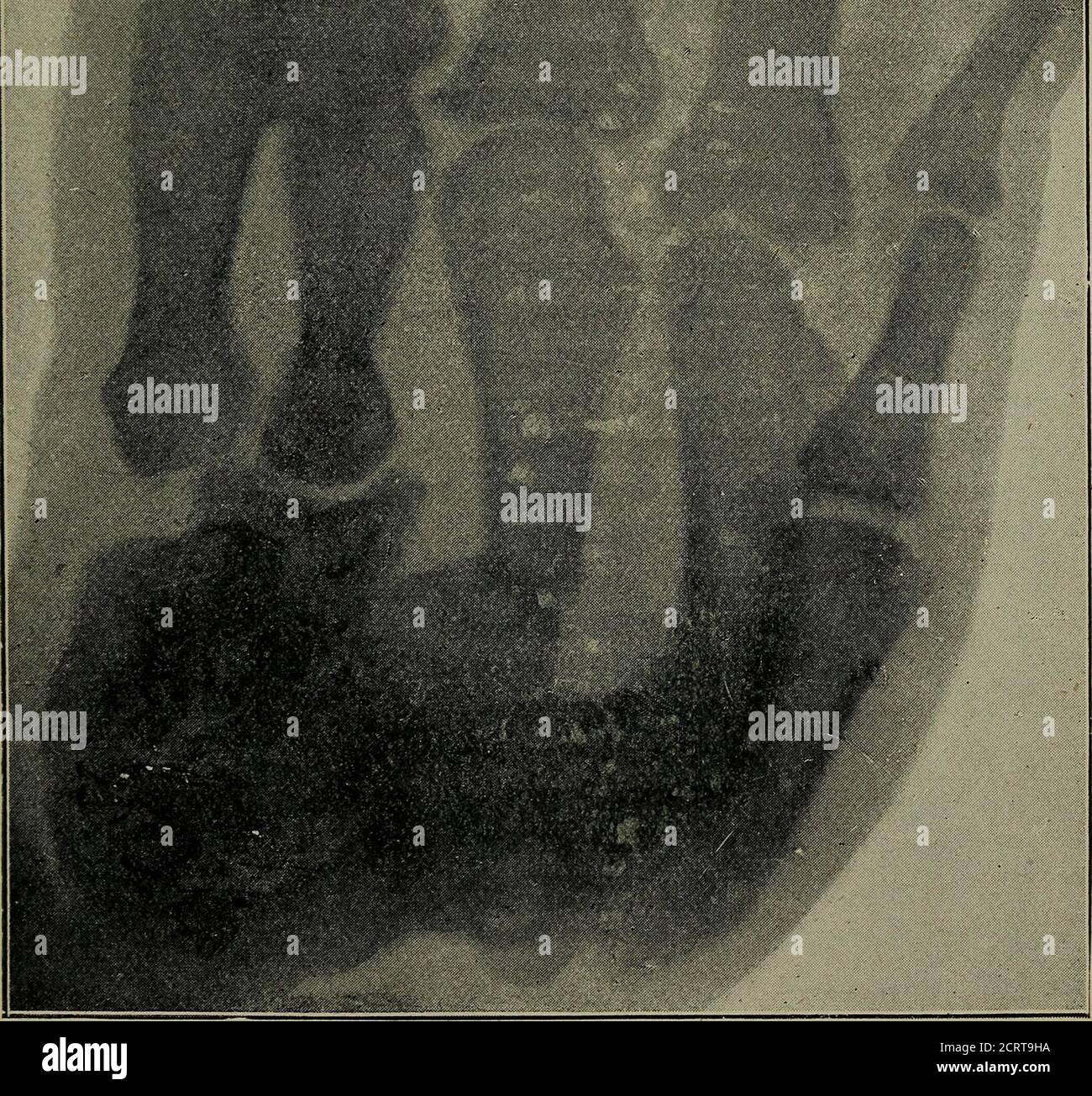 Fracture ulnaire Banque de photographies et d’images à haute résolution ...