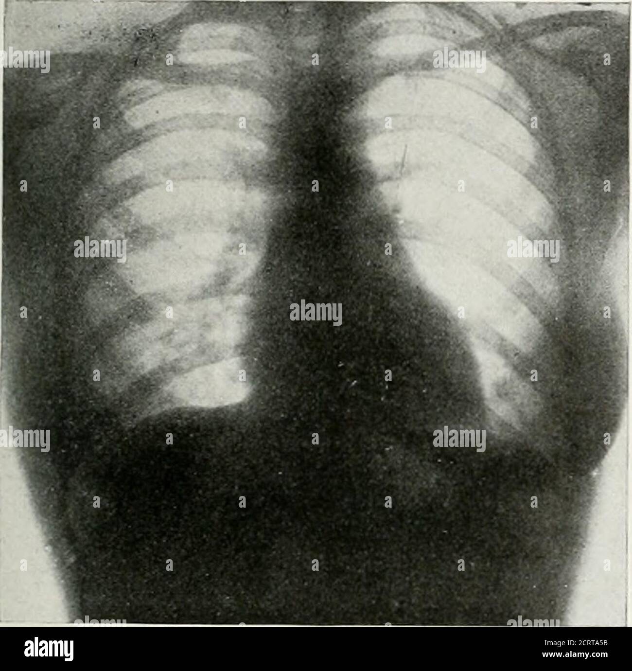 Abcès pulmonaire Banque de photographies et d’images à haute résolution ...