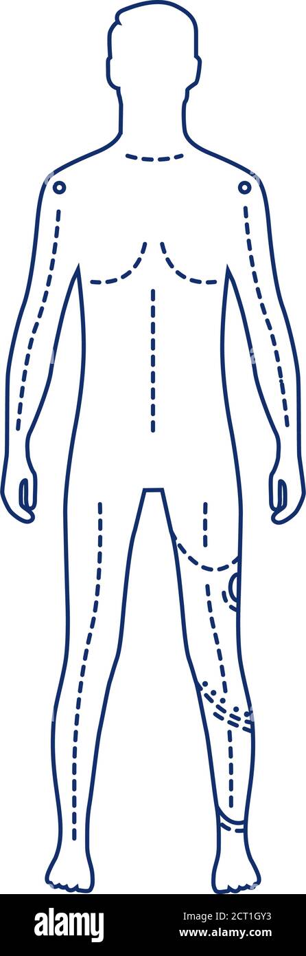 Amputation of a leg Banque d'images vectorielles - Alamy