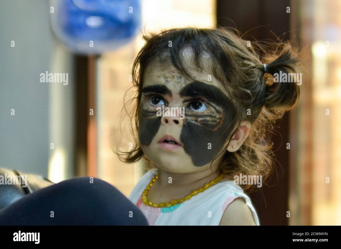 Melanocytic Naevus Banque d'image et photos - Alamy