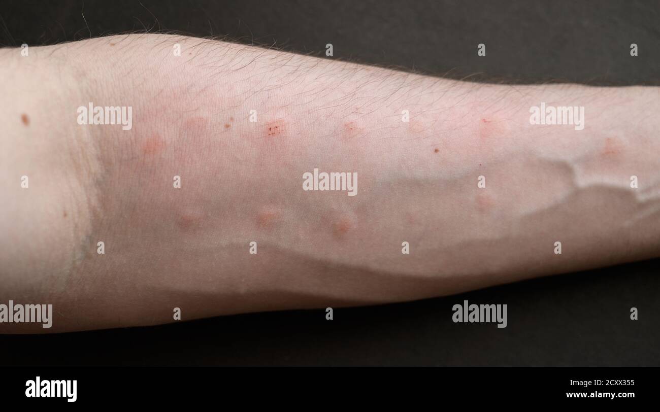 Allergie de la peau sur les bras Banque de photographies et d’images à ...