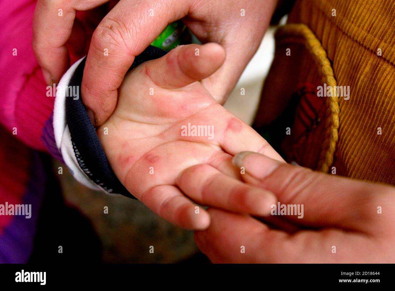 Éruption cutanée enfant main Banque de photographies et d’images à ...