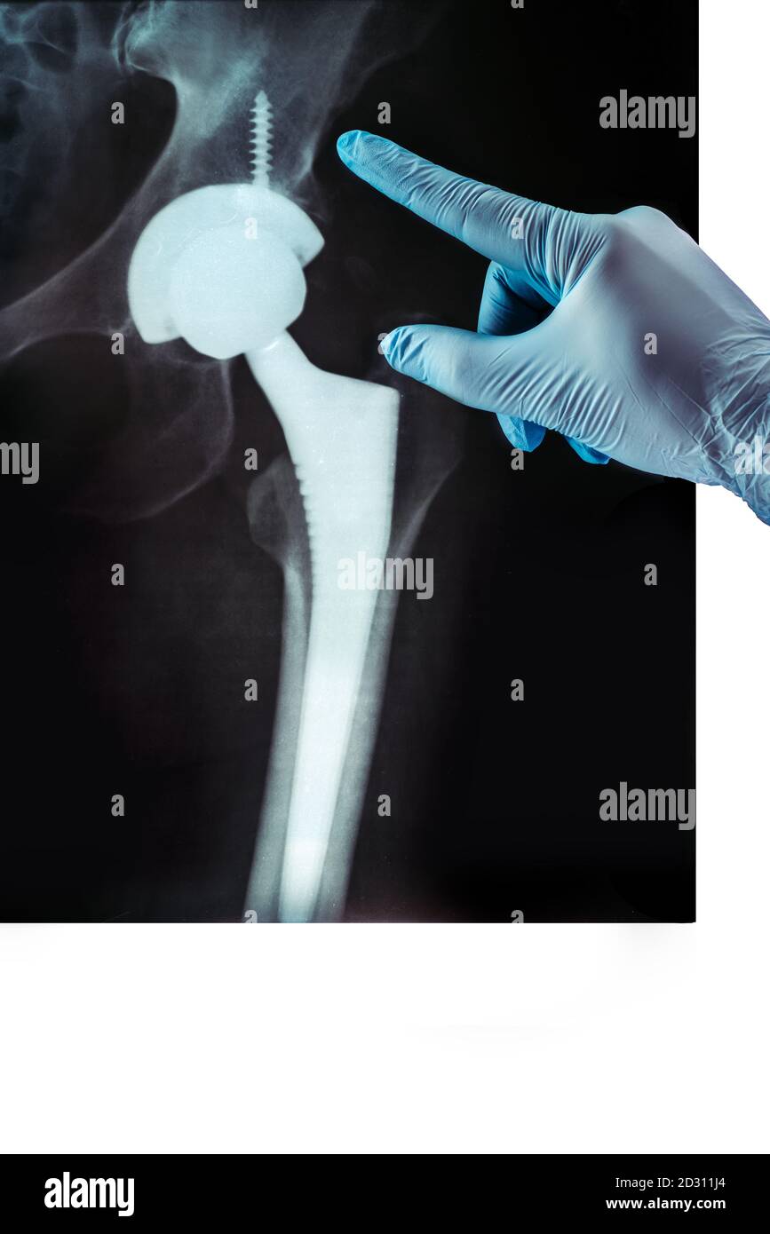 Radiographie de l'endoprothèse pelvienne, prise des maladies ...