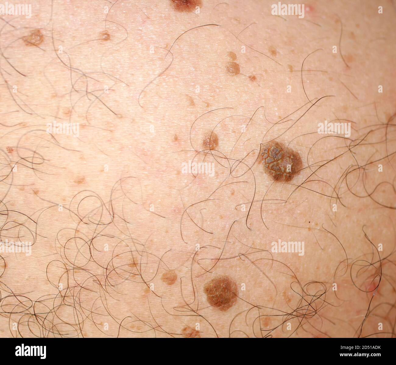 Tache brune sur la peau. Taches pigmentées et moles. Mole et poils de ...