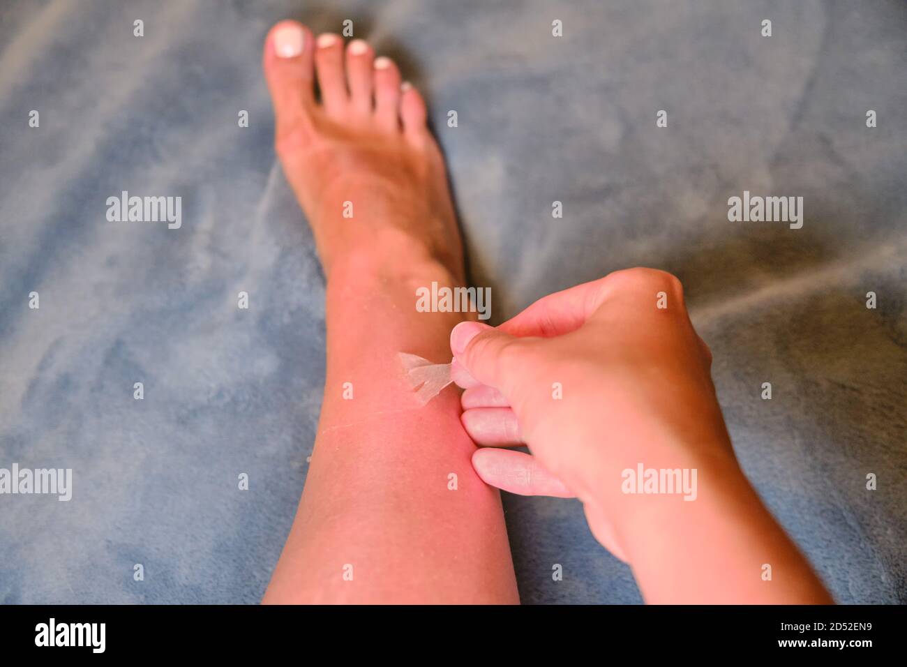 Maladie de peau sur les jambes Banque de photographies et d’images à ...