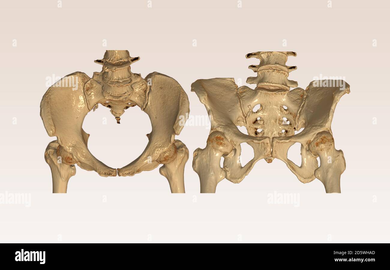 Comparer l'os pelvis de l'acquisition CT avec l'image de rendu 3D de l ...