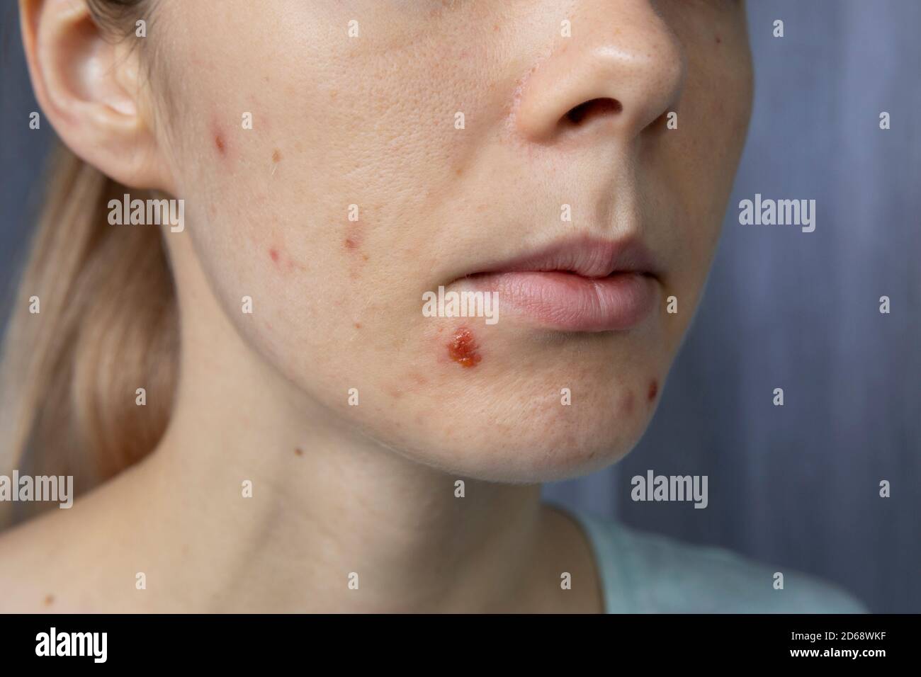 La jeune femme a des problèmes de peau. Fille avec des boutons sur son ...